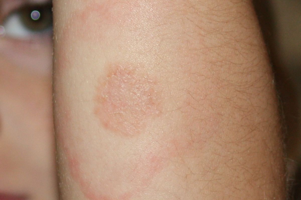 New Ring-Shaped Rash That Spreads? What It Could Be and When to Call